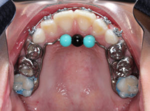 Bluegrass Appliance - Rainier Valley Orthodontics